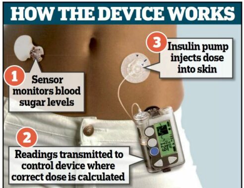 “Bionic” pancreas passes initial tests – ApplySci – Deep Tech Health ...