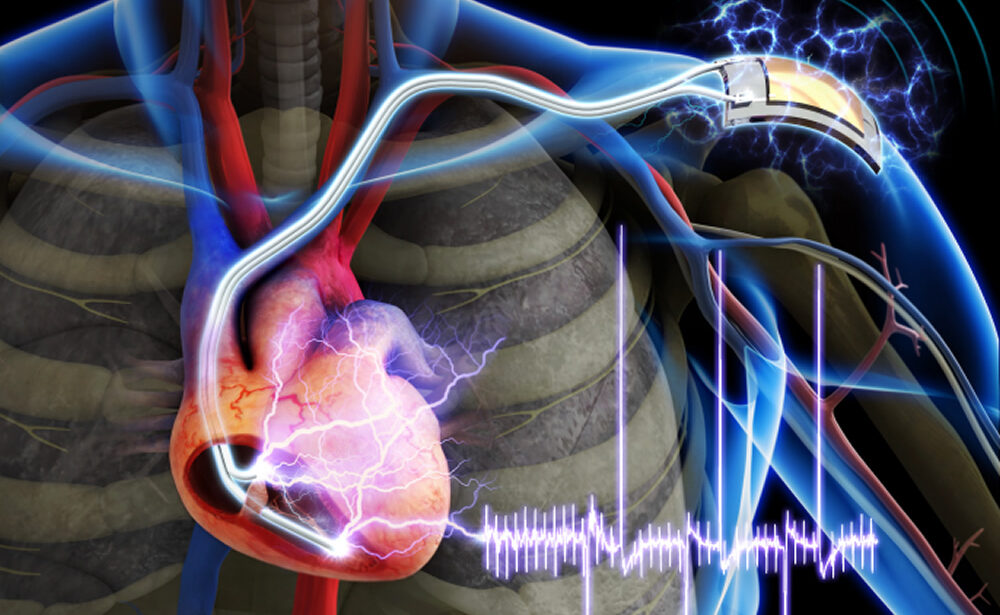 Self powered piezoelectric pacemaker – ApplySci