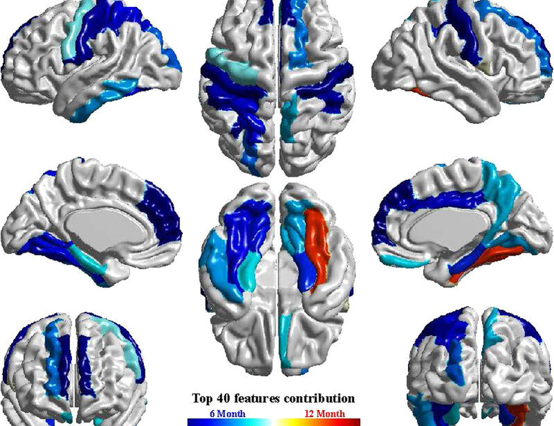 MRI, algorithm predict autism before behavioral symptoms appear – ApplySci