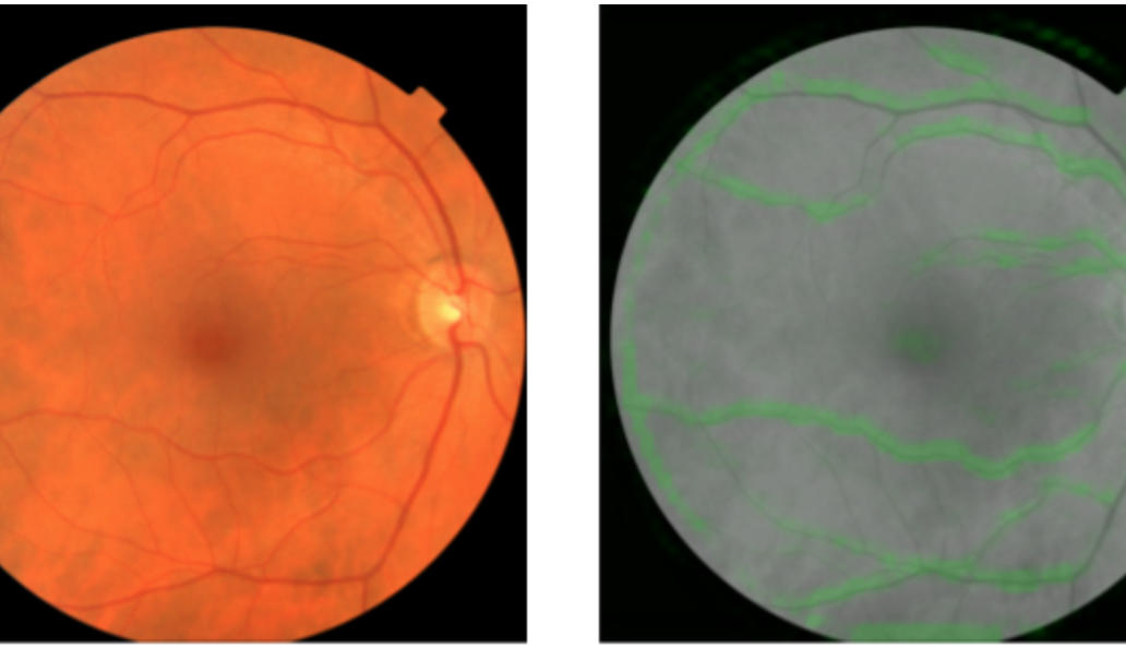 Heart attack, stroke, predicted via retinal images – ApplySci