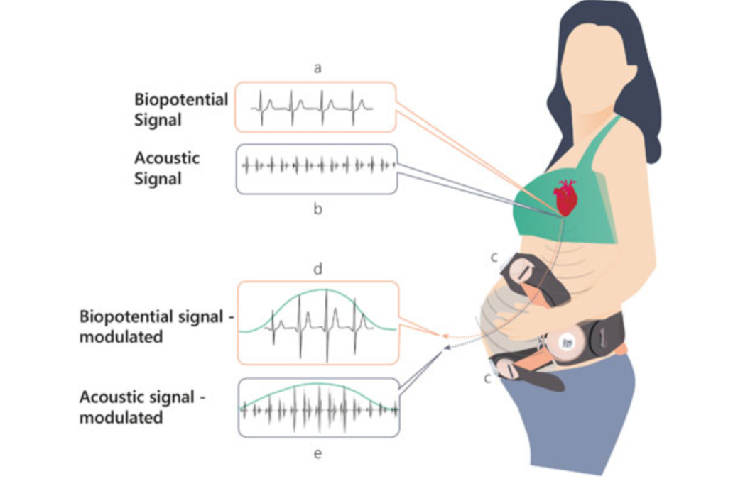 Remote, non-invasive pregnancy monitor tracks uterine activity ...